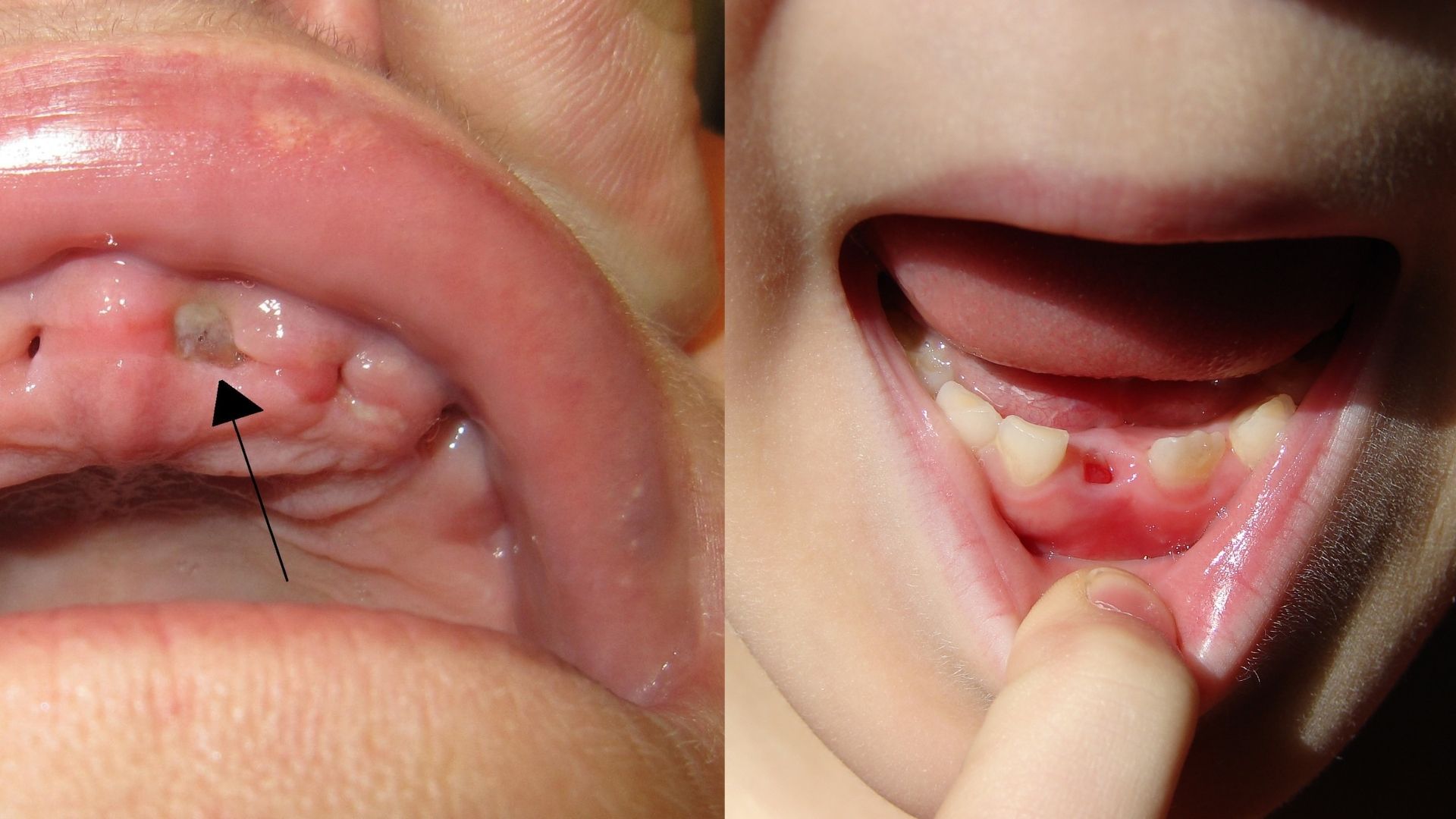 Signs Of A Normal Socket After Tooth Extraction Tooth Remedy