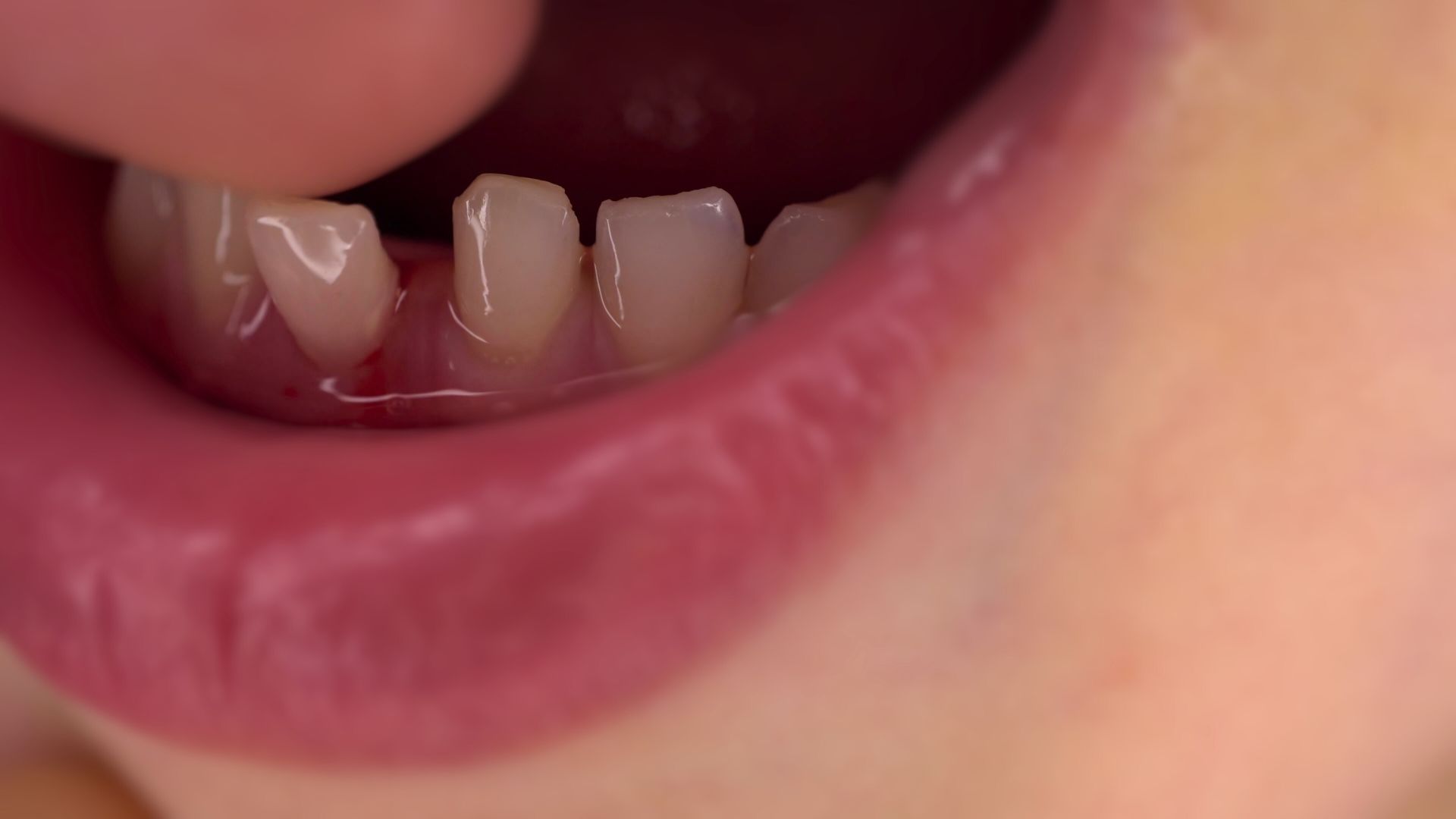 How to Tighten a Loose Tooth at Home: 9 Proven Remedies